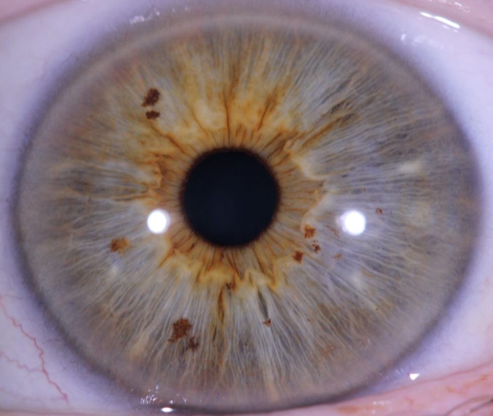 Iridologie - Refletdiris